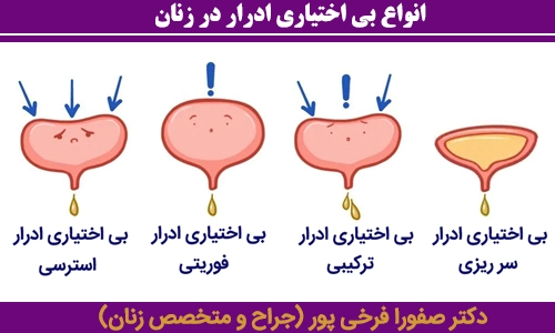 درمان جدید بی اختیاری ادراری زنان با استفاده از آر اف دکتر صفورا فرخی پور